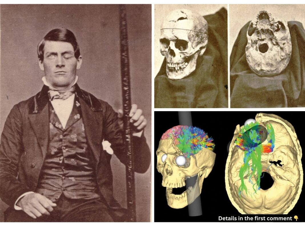 Why Phineas Gage’s Brain Injury Still Fascinates Neuroscientists Today ...